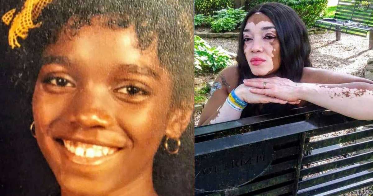 After 32 Years Of Hiding My Vitiligo, I’m Letting My True Beauty Shine ...