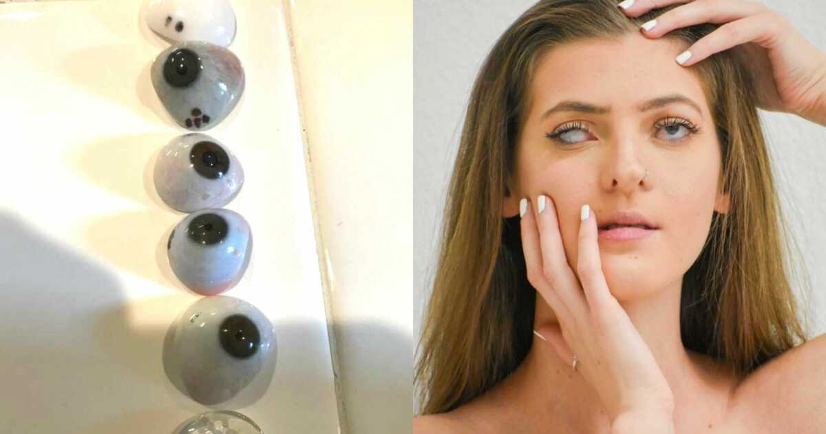 I Have A Rare Genetic Disorder Called Oculofaciocardiodental Syndrome ...