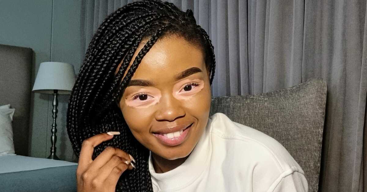 How I Found Confidence After Being Bullied For My Vitiligo – Love What ...